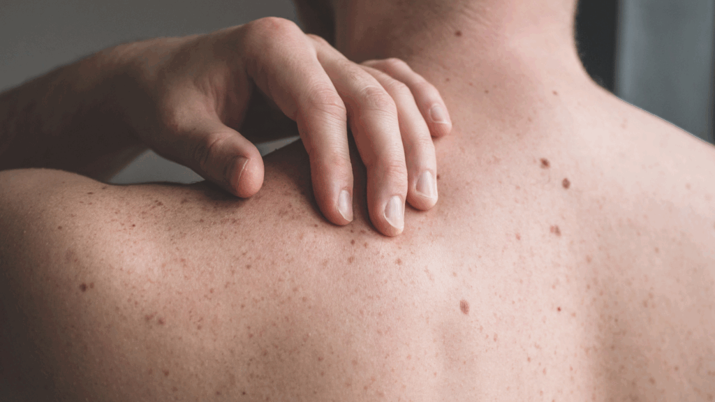 Skin Cancer and Precancerous Changes – Identification and Treatment at ...